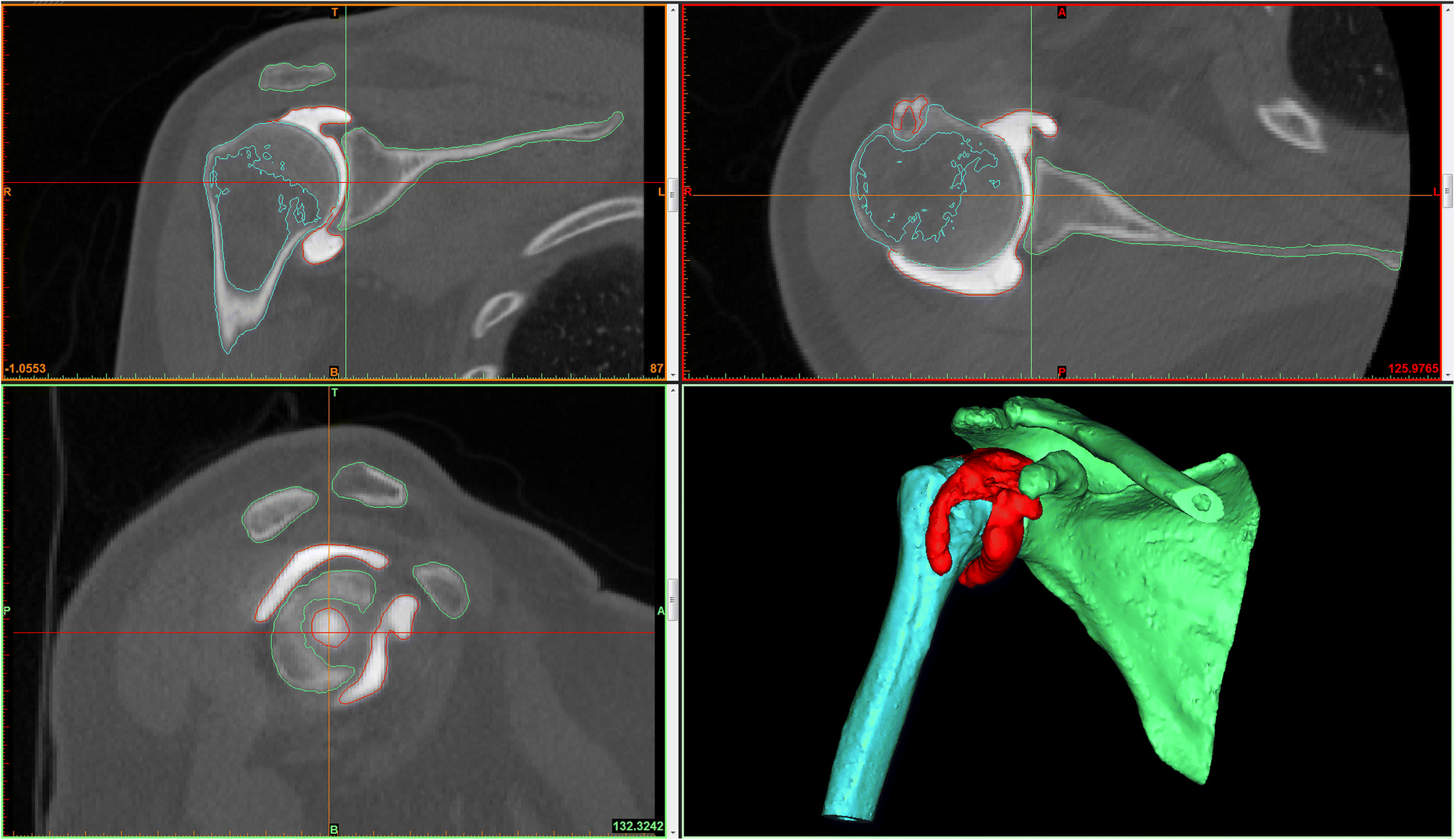 A prototype assembled 3D-printed phantom of the glenohumeral joint for ...