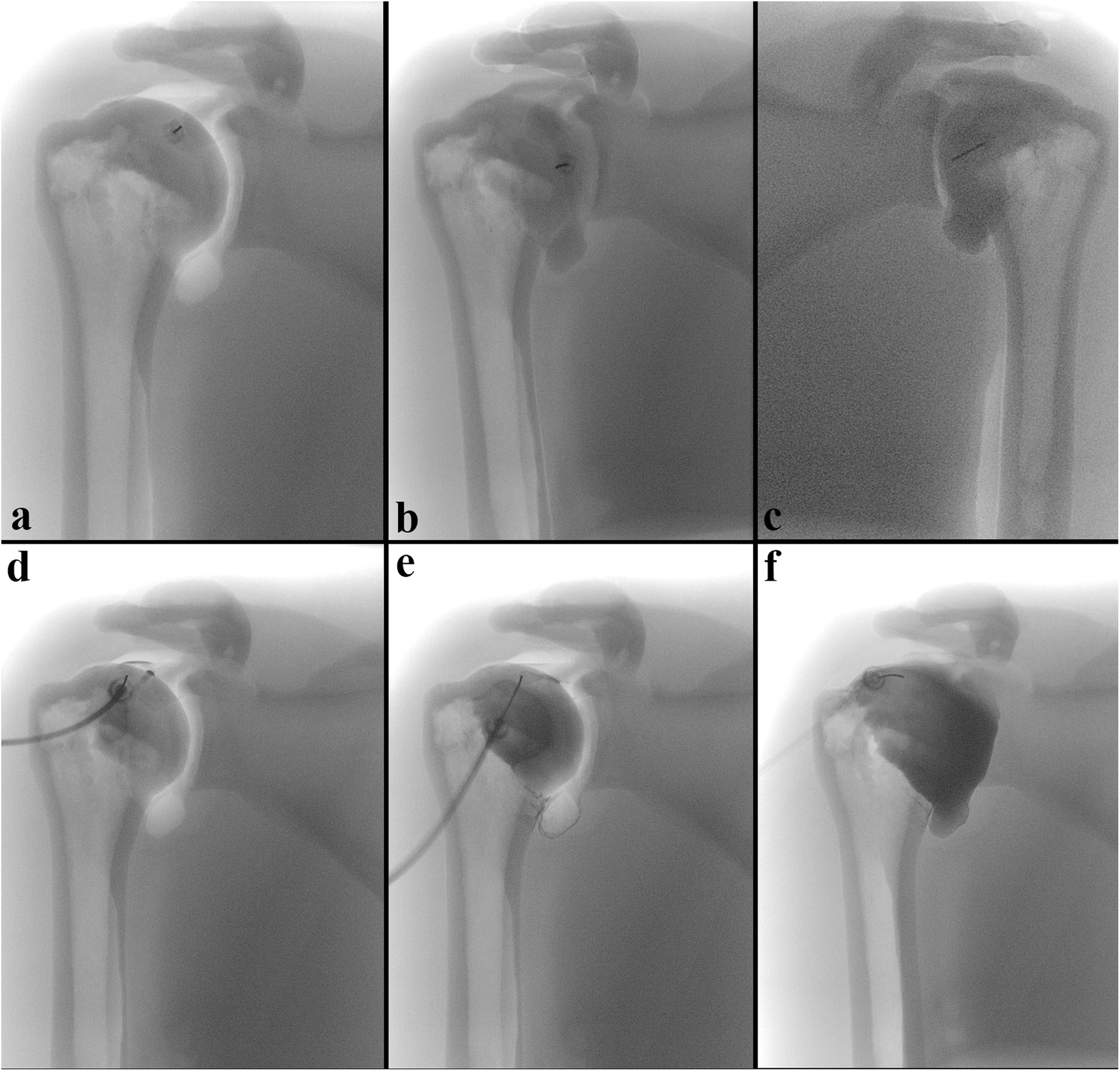 A prototype assembled 3D-printed phantom of the glenohumeral joint for ...