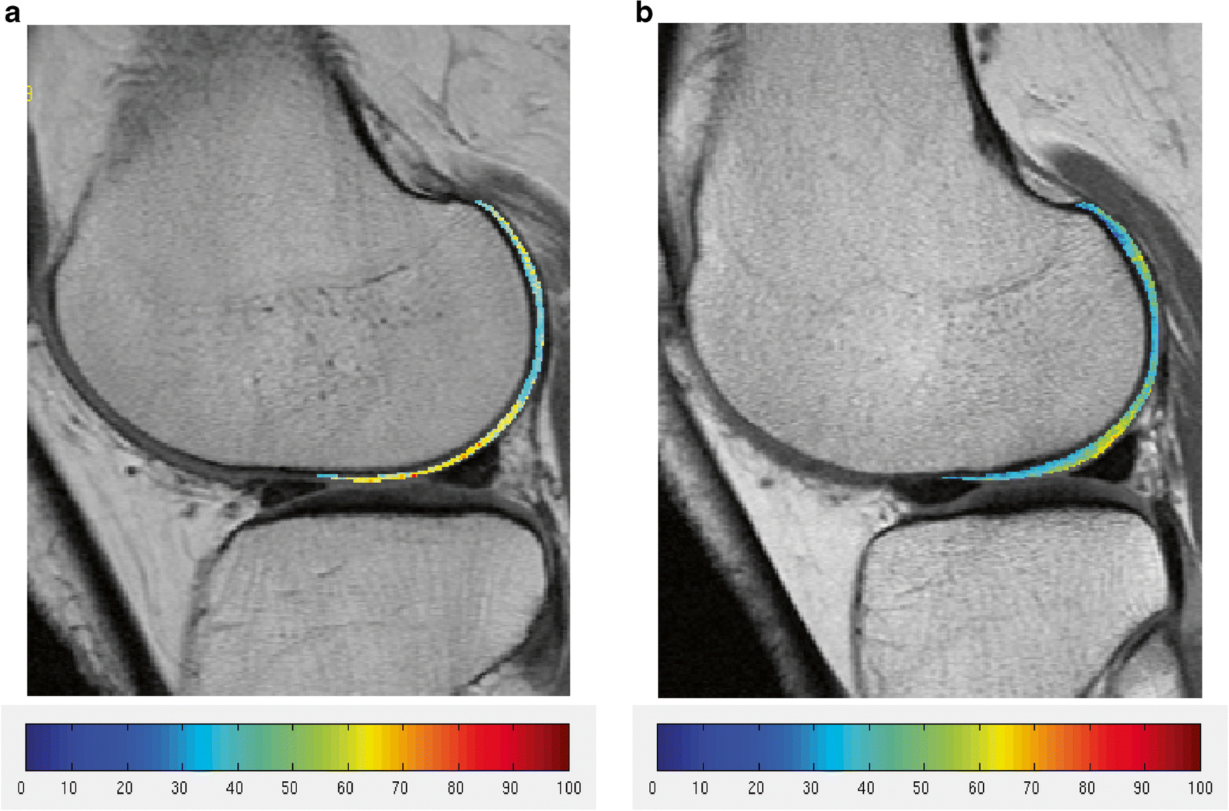 Baseline knee joint effusion and medial femoral bone marrow edema, in ...