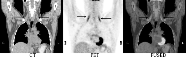 Scalene muscle uptake: a potential pitfall in head and neck PET/CT ...
