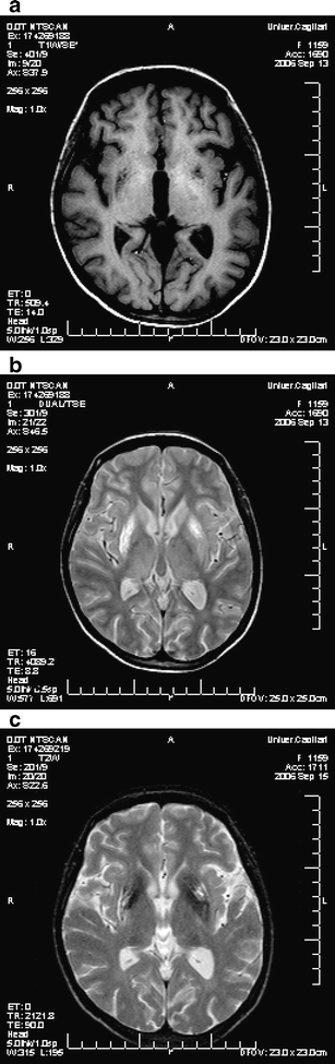 Brain MRI and SPECT in the diagnosis of early neurological involvement ...