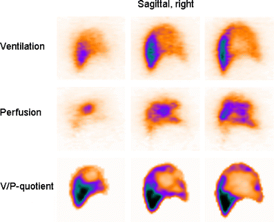 EANM guidelines for ventilation/perfusion scintigraphy | SpringerLink