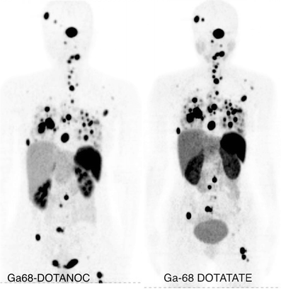 Comparison of 68Ga-DOTATATE and 68Ga-DOTANOC PET/CT imaging in the same ...