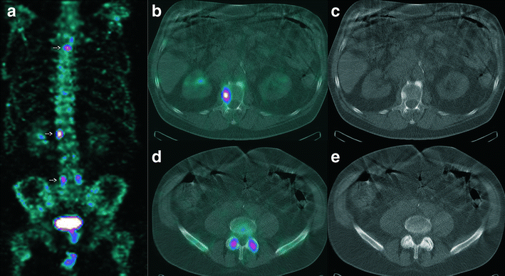 Whole-body SPECT/CT for bone scintigraphy: diagnostic value and effect ...