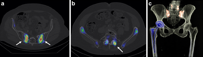 SPECT/CT for imaging of the spine and pelvis in clinical routine: a ...