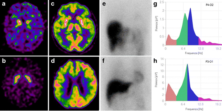 Is dopamine transporter invariably impaired at the time of diagnosis in ...