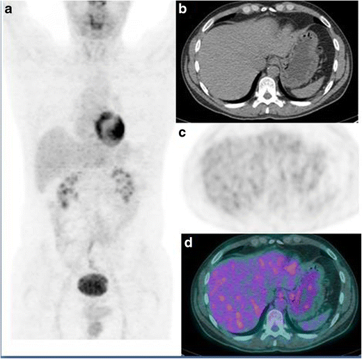 18F-FDG PET/CT in gastric MALT lymphoma: a bicentric experience ...