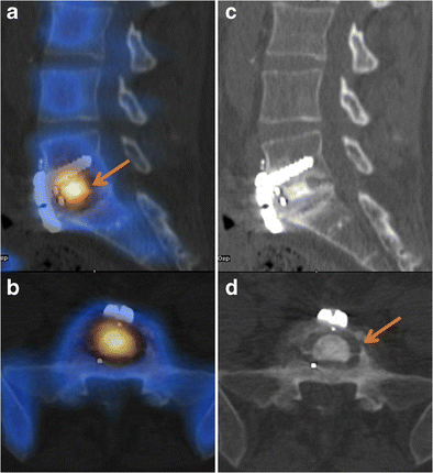Bone SPECT/CT in the postoperative spine: a focus on spinal fusion ...