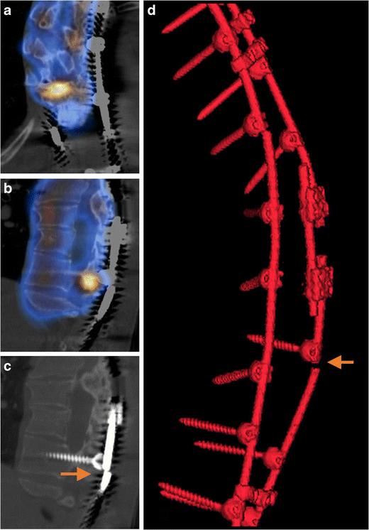Bone SPECT/CT in the postoperative spine: a focus on spinal fusion ...