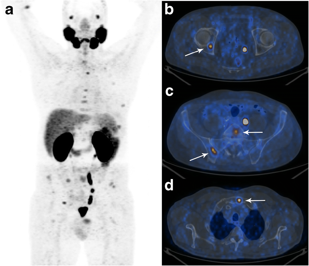 68Ga-PSMA-11 PET/CT in prostate cancer patients with biochemical ...