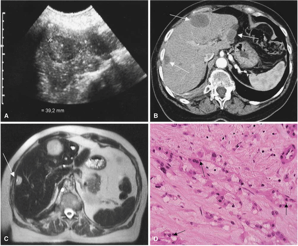 Epithelioid hemangioendothelioma of the liver | SpringerLink