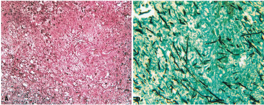 Fatal, complete splenic infarction and hepatic infection due to ...