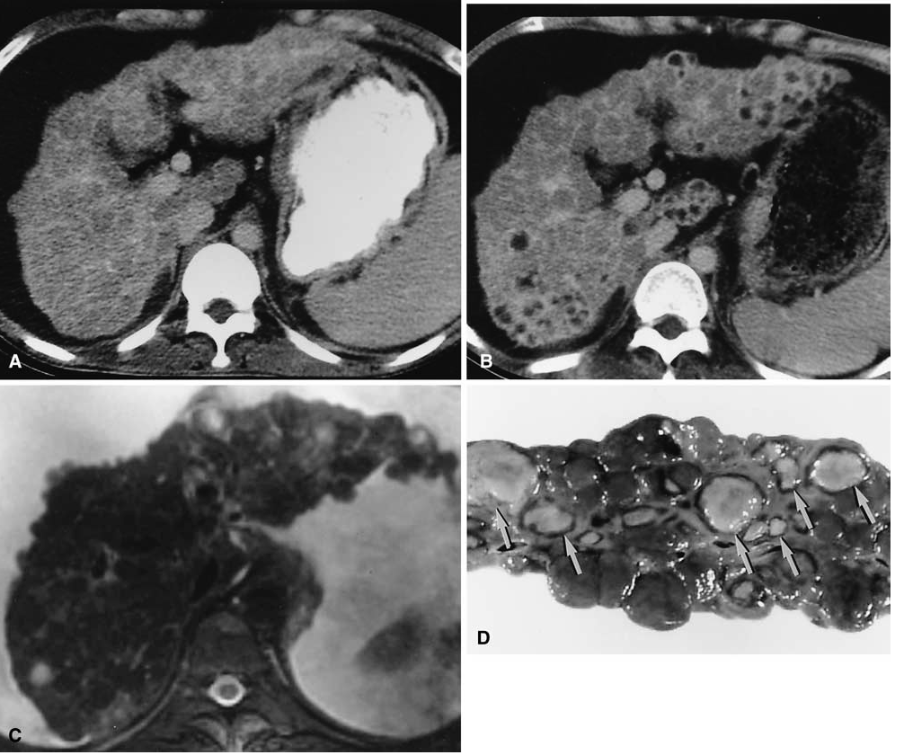 Multiple infarcted regenerative nodules in liver cirrhosis after ...