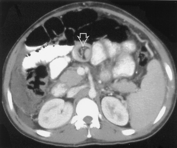 Proximal small bowel intussusceptions in adults: CT appearance and ...