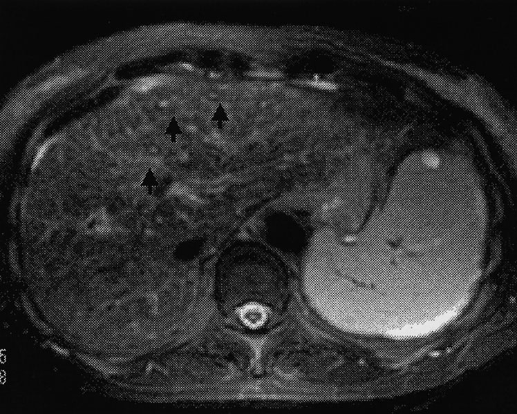MRI findings of primary biliary cirrhosis: correlation with Scheuer ...