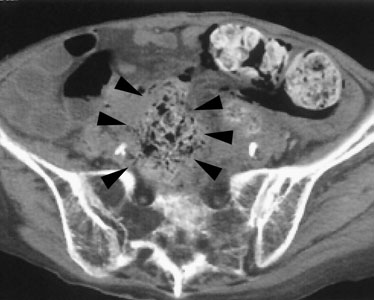Gastrointestinal tract perforation: CT diagnosis of presence, site, and ...