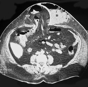 Unusual perforated appendicitis within umbilical hernia: CT findings ...