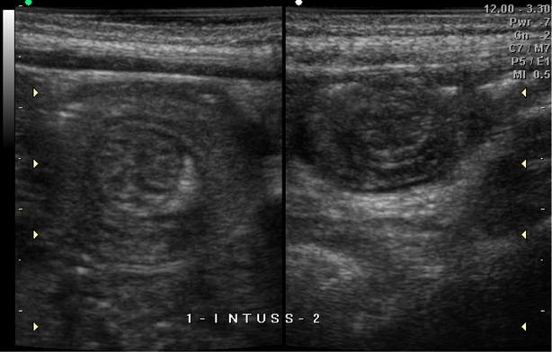 Transient small bowel intussusceptions: ultrasound findings and ...