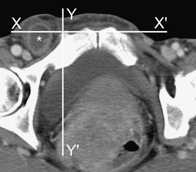 The pubic tubercle: a CT landmark in groin hernia | SpringerLink