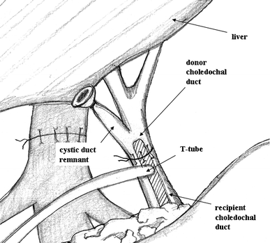Biliary complications after orthotopic liver transplantation: MRCP ...