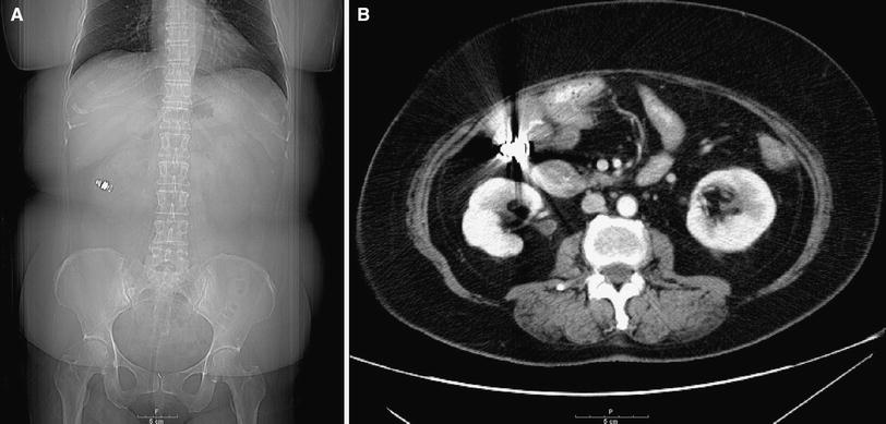 Small bowel obstruction due to an impacted endoscopy capsule | SpringerLink