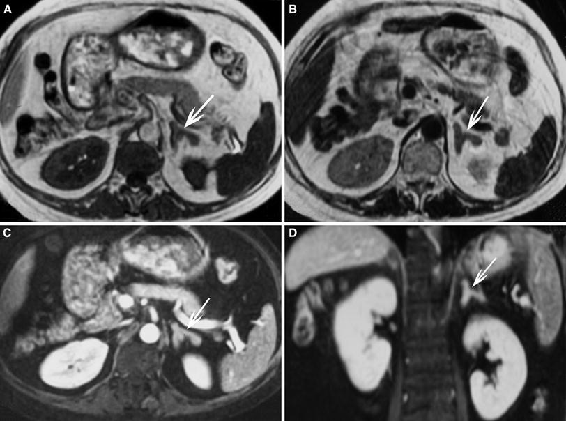 Addison’s disease due to adrenal tuberculosis: MRI features | SpringerLink