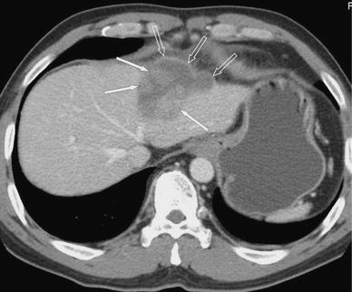 The various manifestations of ruptured hepatocellular carcinoma: CT ...