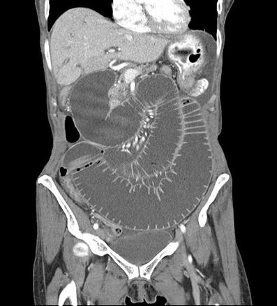 Partial small bowel obstruction: clinical issues and recent technical ...
