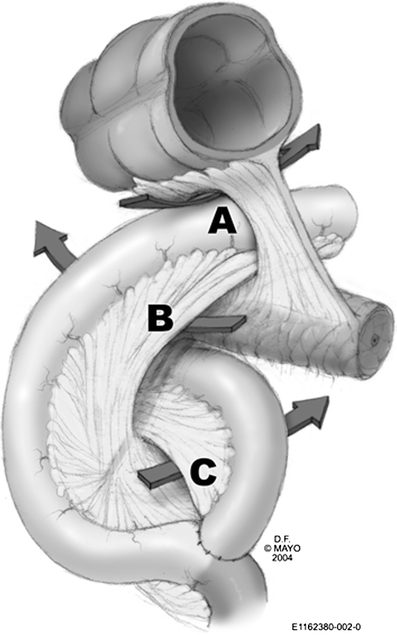 Partial small bowel obstruction: clinical issues and recent technical ...