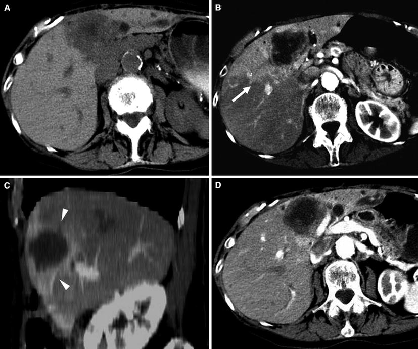 Transient hepatic attenuation difference (THAD) in biliary duct disease ...