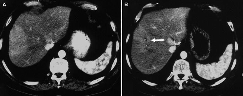 Transient hepatic attenuation difference (THAD) in biliary duct disease ...