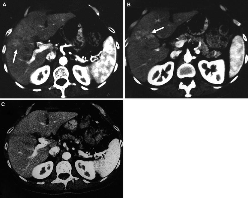 Transient hepatic attenuation difference (THAD) in biliary duct disease ...