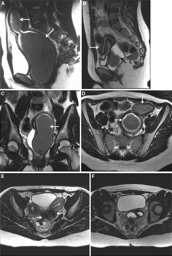 Mullerian duct anomalies: MR imaging | SpringerLink