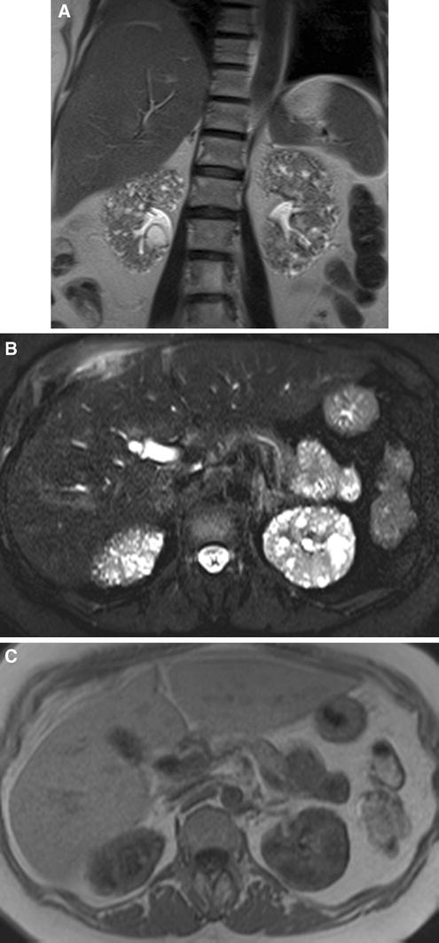 MR findings of lithium-related kidney disease: preliminary observations ...