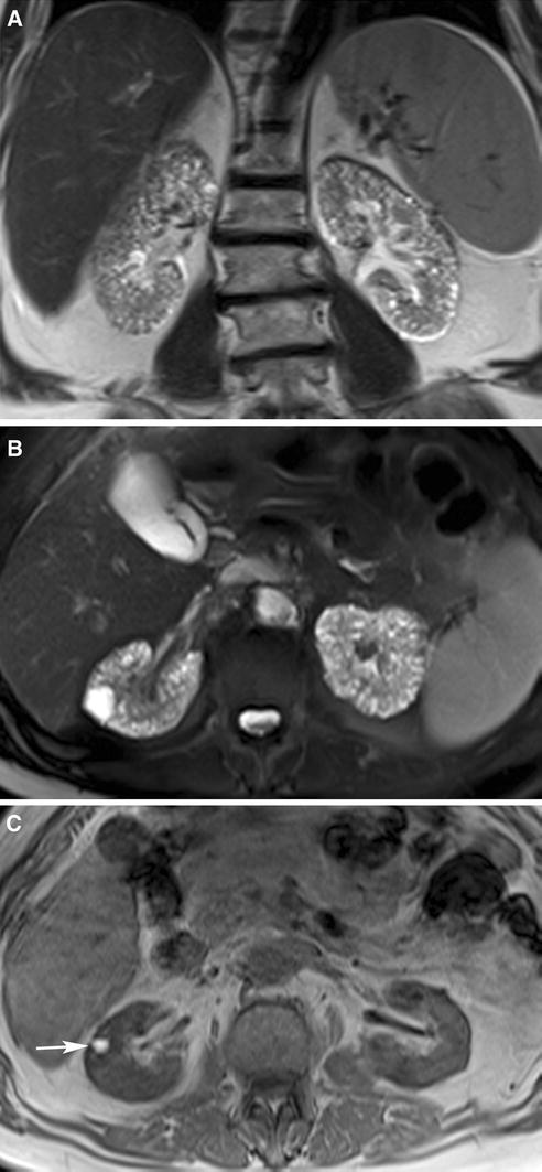 MR findings of lithium-related kidney disease: preliminary observations in four patients ...