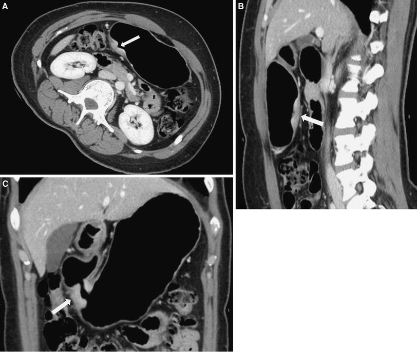 Gastric cancer: Imaging and staging with MDCT based on the 7th AJCC ...