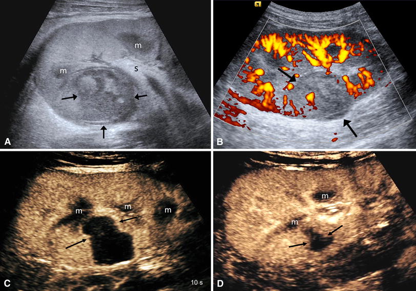 Acute complicated pyelonephritis: contrast-enhanced ultrasound ...