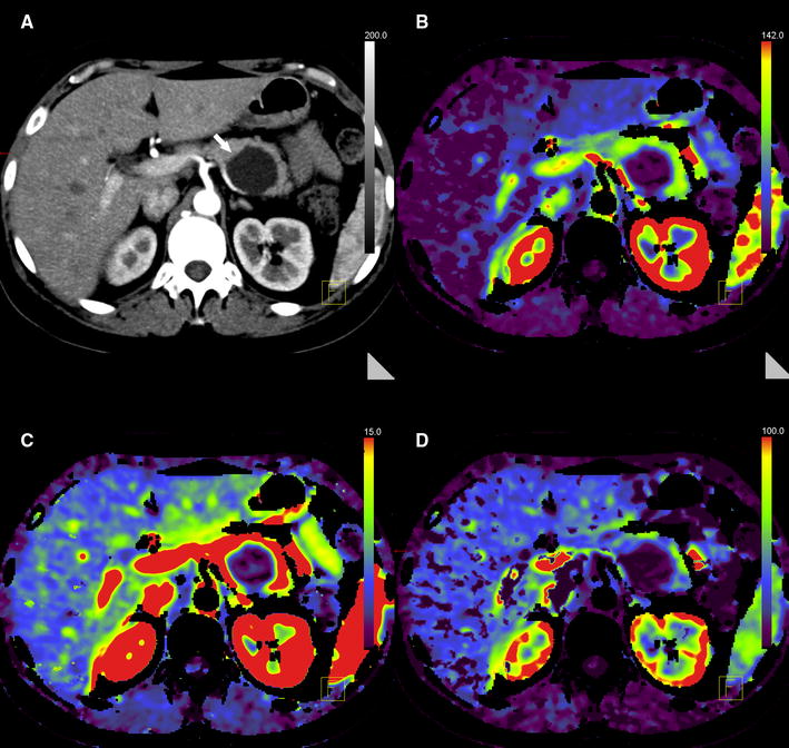 Tissue perfusion in pathologies of the pancreas: assessment using 128 ...