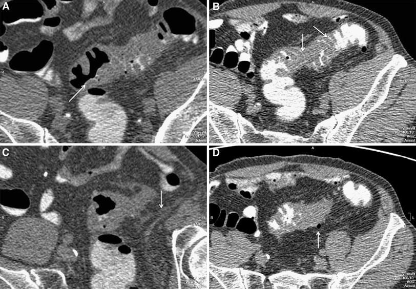 Chronic diverticulitis vs. colorectal cancer: findings on CT ...