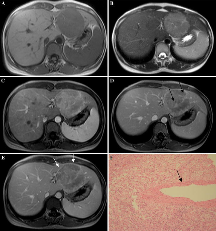 Epithelioid angiomyolipoma of the liver: CT and MRI features | SpringerLink