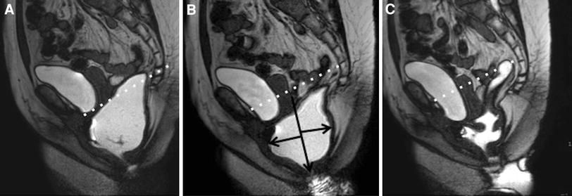 Functional disorders of the ano-rectal compartment of the pelvic floor ...