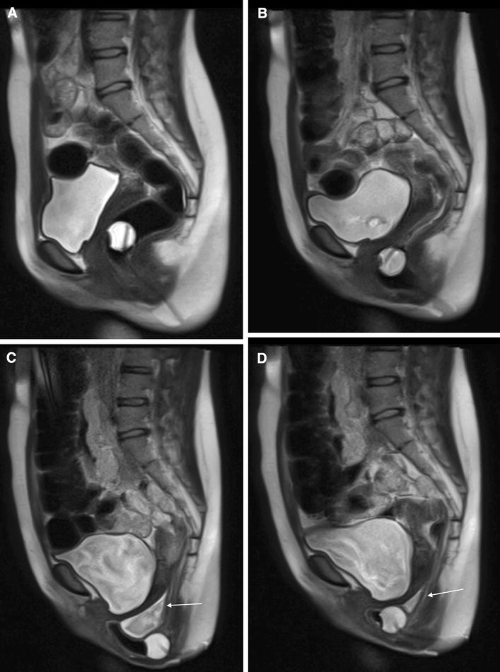 Functional disorders of the ano-rectal compartment of the pelvic floor ...