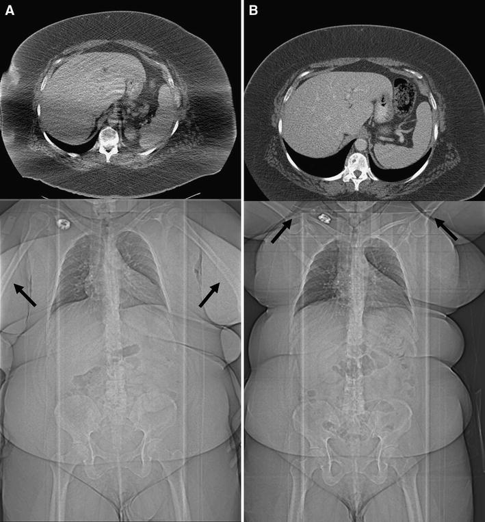Imaging obese patients: problems and solutions | SpringerLink