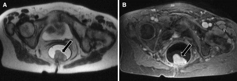 Benign and malignant tumors of the rectum and perirectal region ...