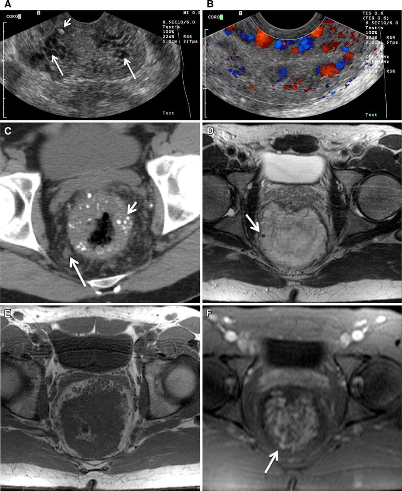 Benign and malignant tumors of the rectum and perirectal region ...