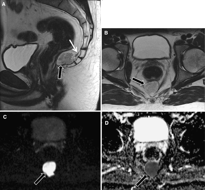 Benign and malignant tumors of the rectum and perirectal region ...