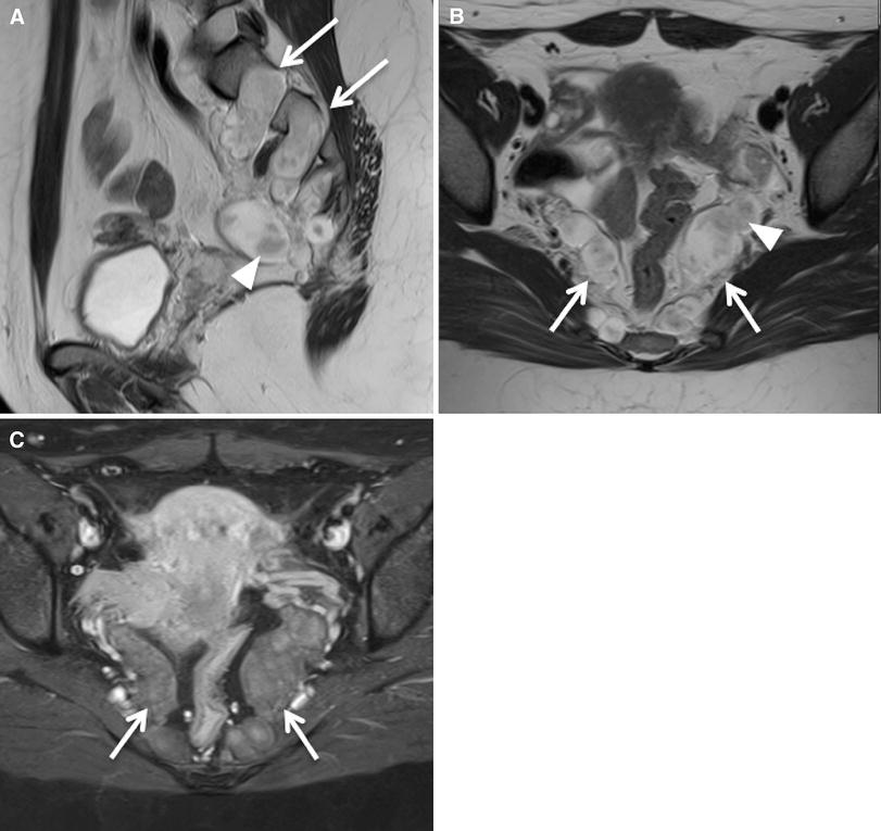 Benign and malignant tumors of the rectum and perirectal region ...