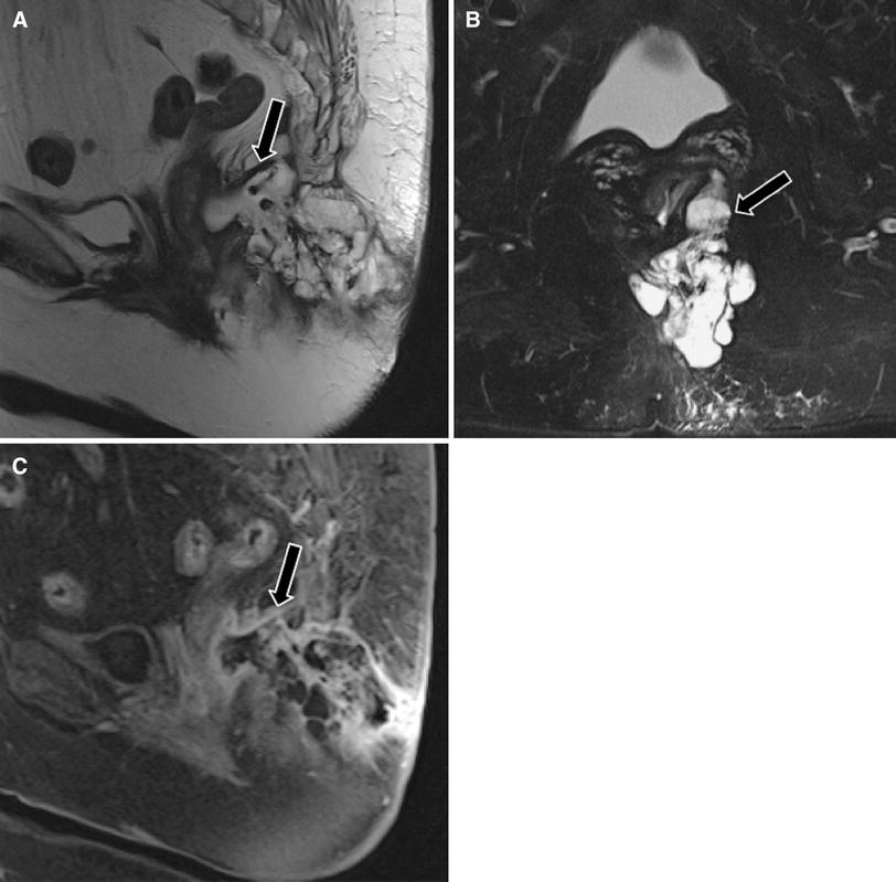 Benign and malignant tumors of the rectum and perirectal region ...