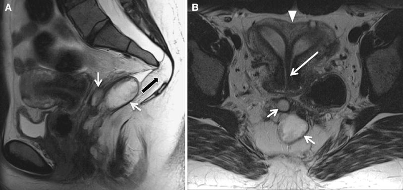 Benign and malignant tumors of the rectum and perirectal region ...
