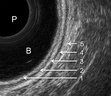 Benign and malignant tumors of the rectum and perirectal region ...